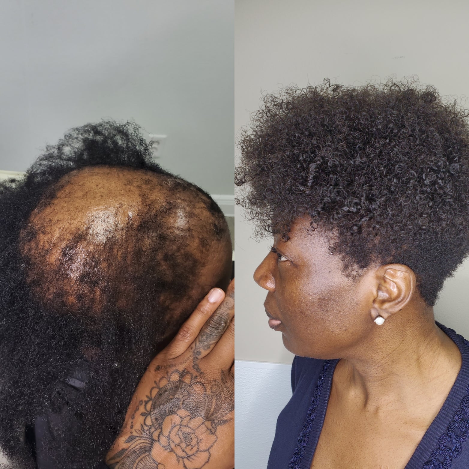Houston Hair Loss Specialist | The Alopecia Doctor – The Alopecia ...