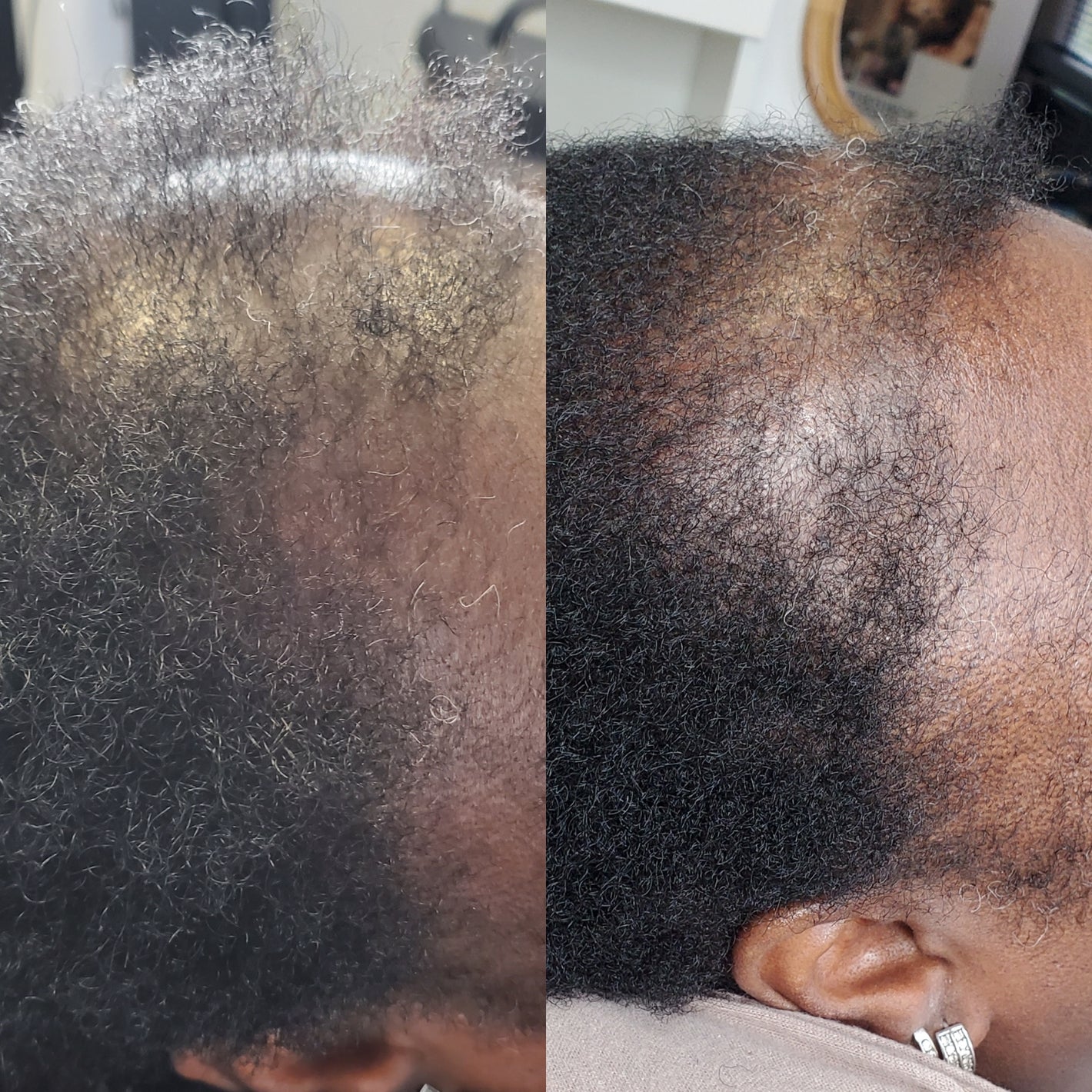 Houston Hair Loss Specialist | The Alopecia Doctor – The Alopecia ...